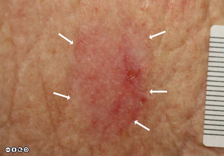 Basal cell carcinoma - Skin Cancer 909