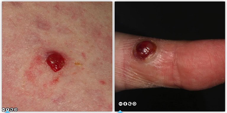 Mimics of skin cancer (ii) - Skin Cancer 909